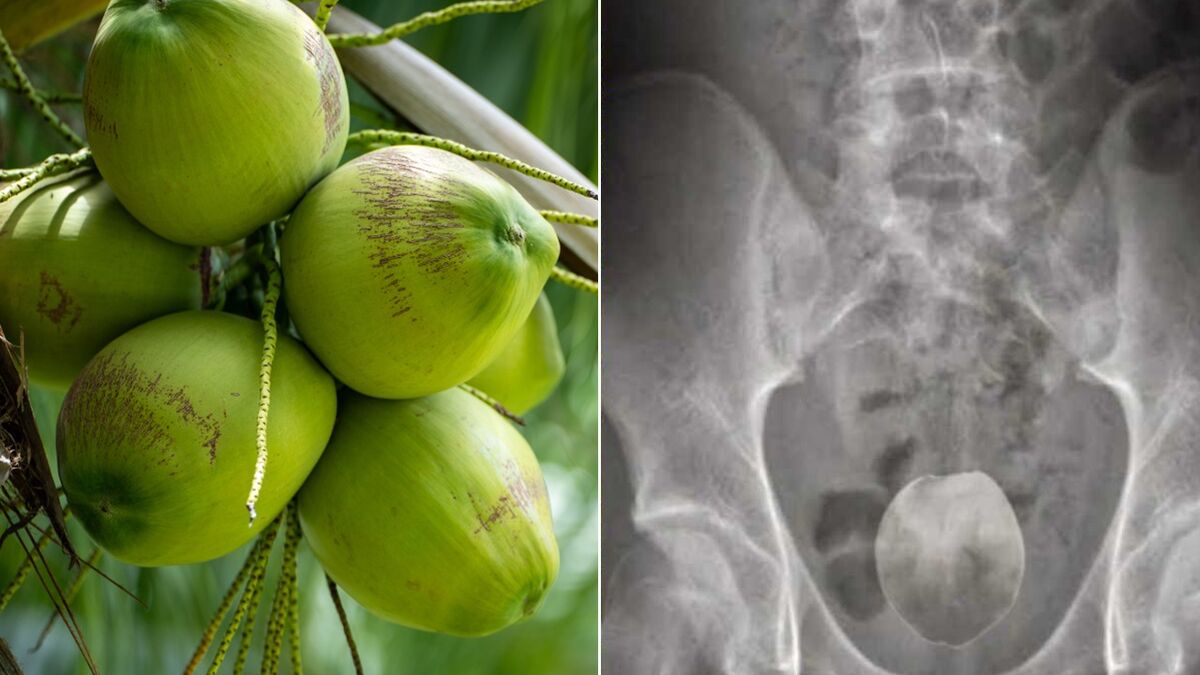 Veja: Homem é internado após introduzir coco verde no ânus • DOL