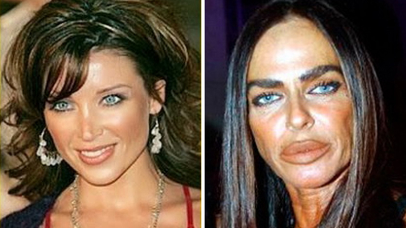 10 famosas com os rostos deformados por cirurgia plástica